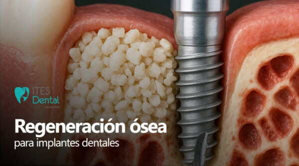 Regeneración ósea para implantes dentales